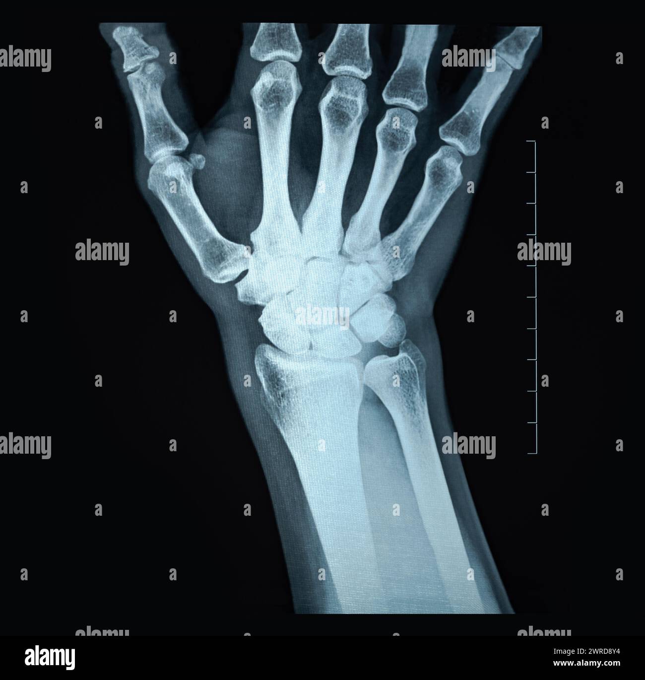 X Ray Of Hand And Wrist